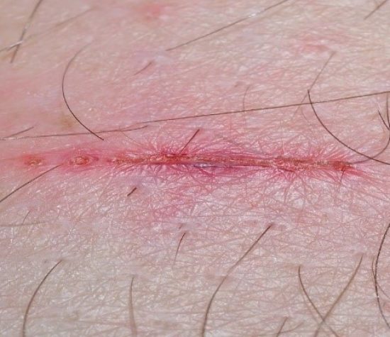 Pressure area care and wound care (Tissue Viability) – Full day course ...